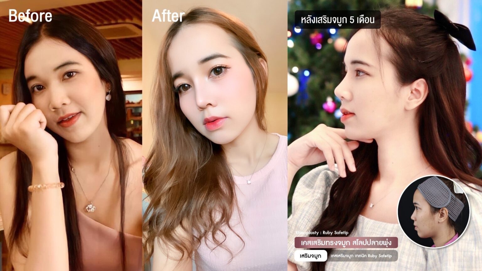 Rhinoplasty Augmentation เสริมจมูก กับหมอเก่ง Ruby Clinic Thailand