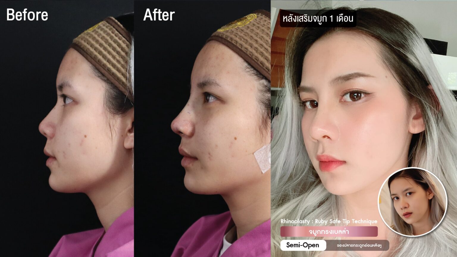 Rhinoplasty Augmentation เสริมจมูก กับหมอเก่ง Ruby Clinic Thailand
