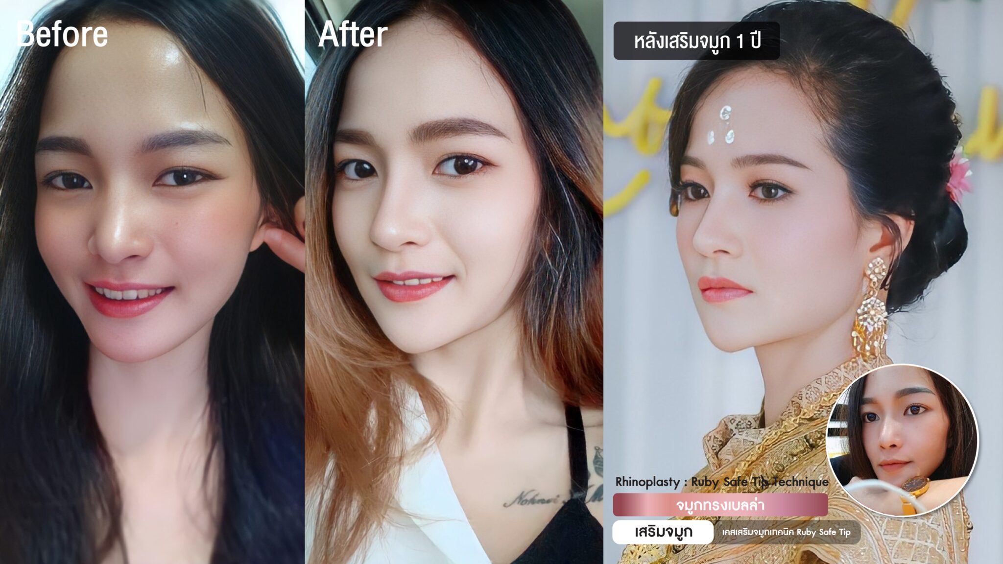 Rhinoplasty Augmentation เสริมจมูก กับหมอเก่ง Ruby Clinic Thailand