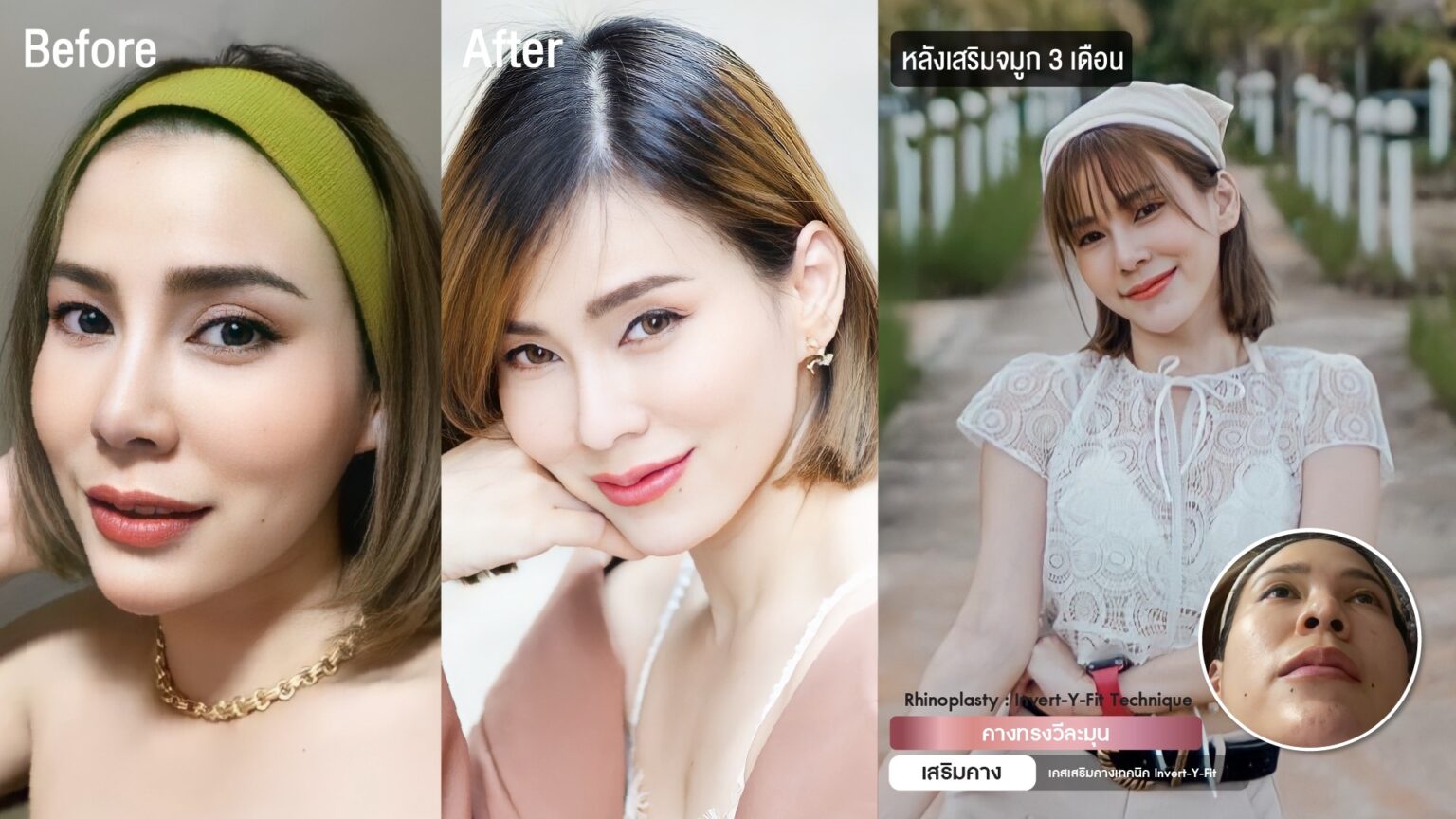 Rhinoplasty Augmentation เสริมจมูก กับหมอเก่ง Ruby Clinic Thailand